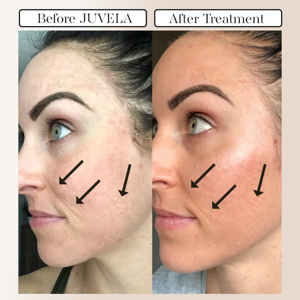 JUVELA Micro-Infusion System – Juvela